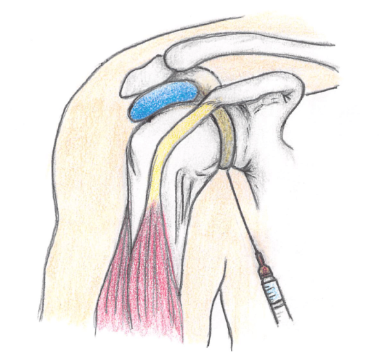 Joint Injections - Serenity Surgical